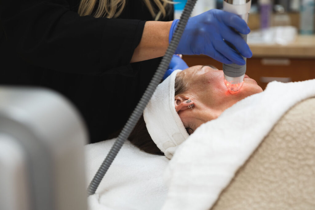 RF Microneedling in Beloit - Medical Grade Aesthetics