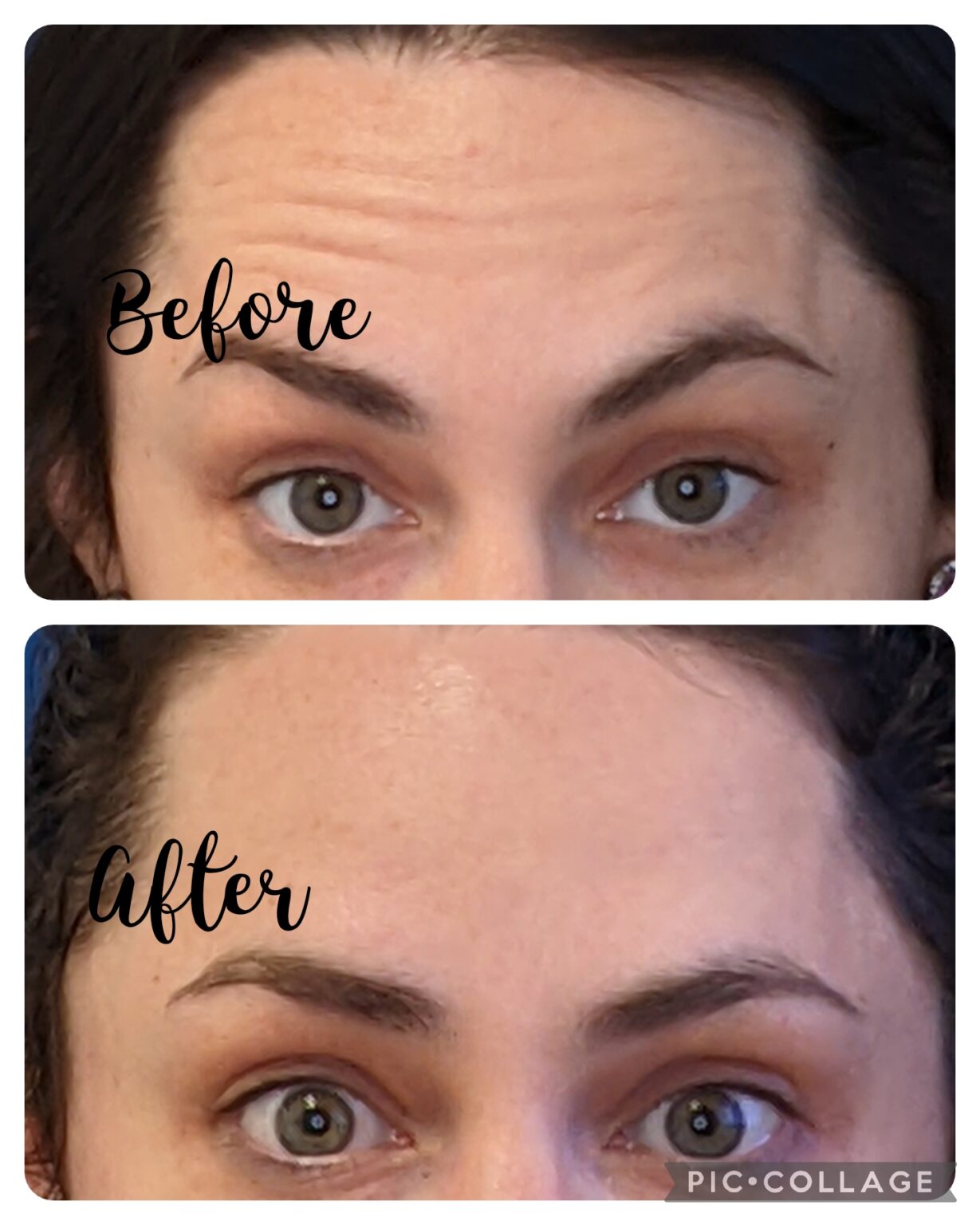 Botox 2 - Medical Grade Aesthetics